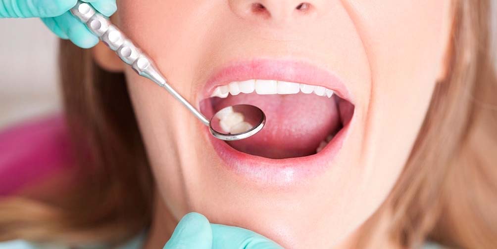 White Filling (Composite) - Marylebone Dental Care